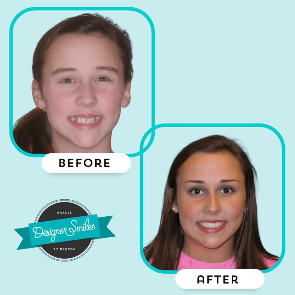 Before & Afters | Orthodontics Oxford | Designer Smiles by Benton